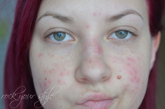 michaelfranklinns: Kleine Pickel Im Gesicht Ausschlag