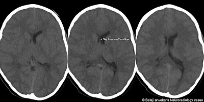 Dr Balaji Anvekar FRCR: Mild lateral ventricle Asymmetry