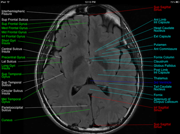 Anatomy Brain Mri - Anatomical Charts & Posters
