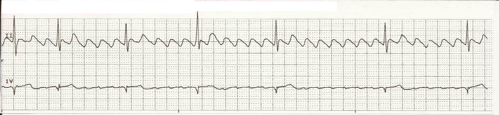 EKG Rhythm Strips 09