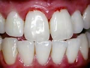 Easy Medical Terminology : Medical Terminology Word Pyrorrhea