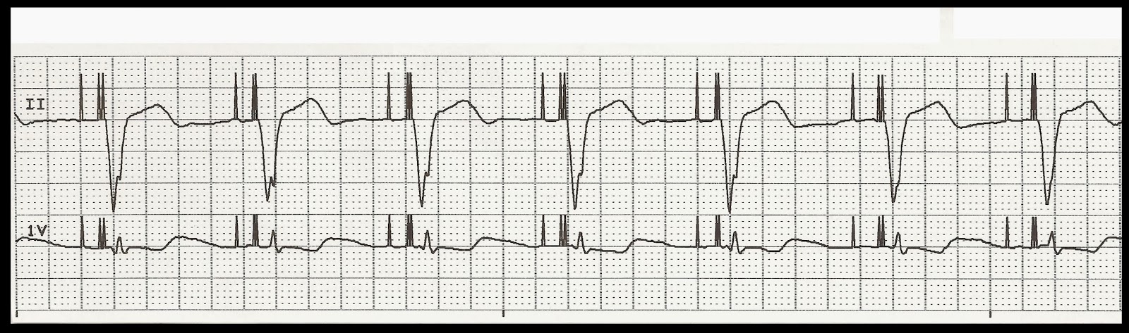 EKG Rhythm Strip Quiz 188