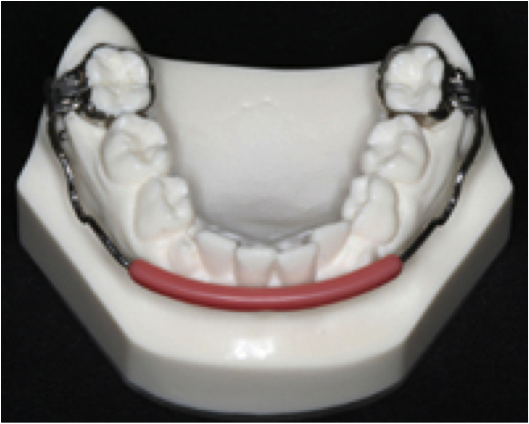 Open Lab UPC Ortodoncia 2012 : LIP BUMPER