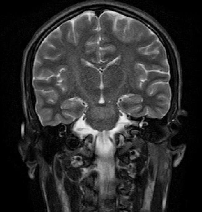 Rhombencephalitis-MRI - Sumer's Radiology Blog