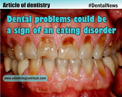 DENTAL NEWS: Dental problems could be a sign of an eating disorder ...