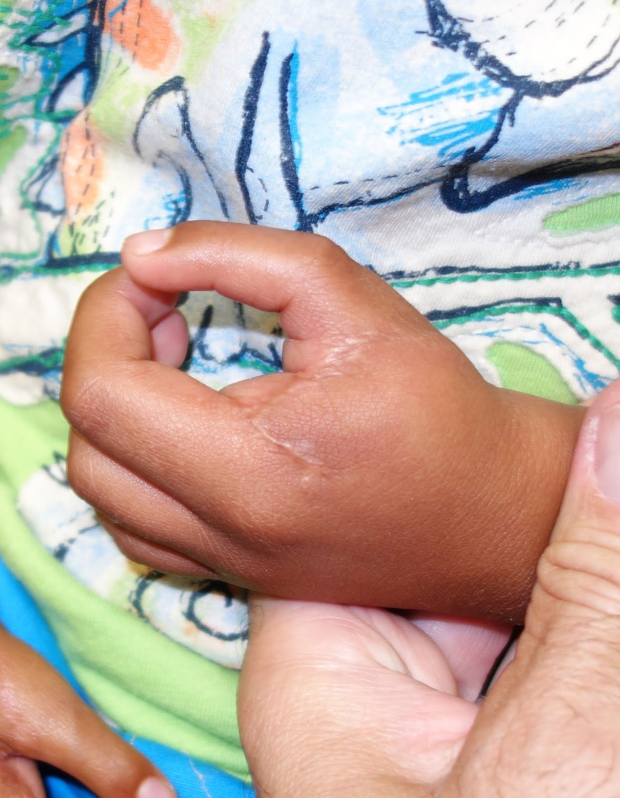 Even More Thoughts on Pollicization | Congenital Hand and Arm ...