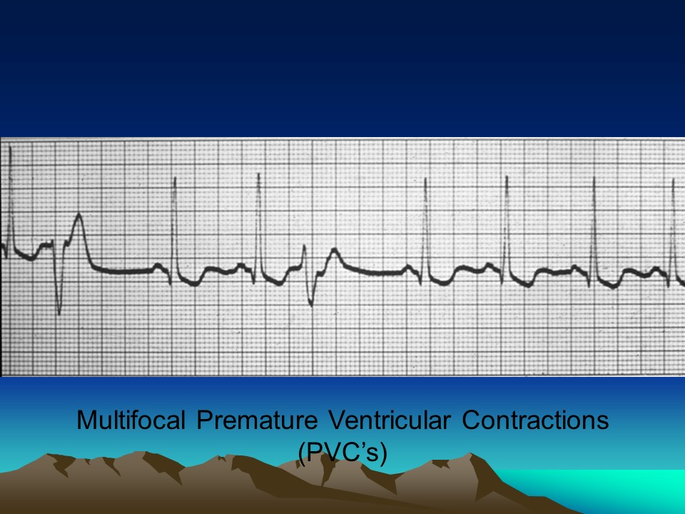 CVT Mohd Farid: Electrocardiogram ECG Part III Basic ECG Rhythm Pattern ...
