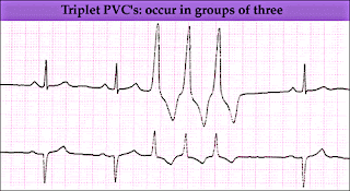 Premature Ventricular Contraction / Ventrikular Ekstrasistol | INA - ECG