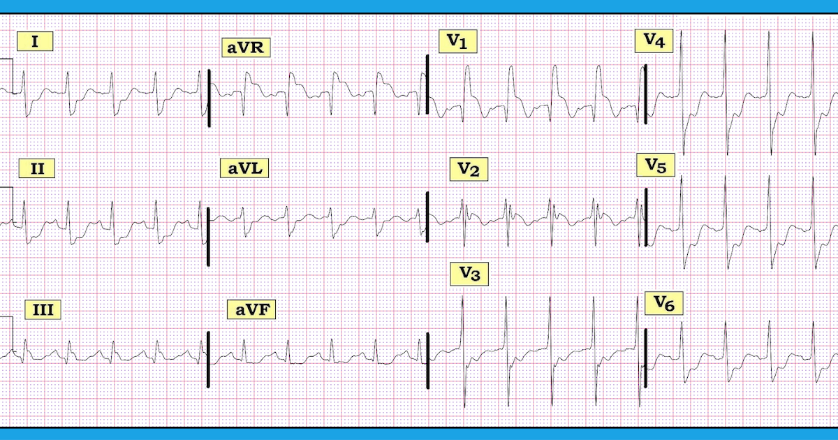 ECG Interpretation: ECG Blog #145 – (ST Depression – STEMI – BBB)