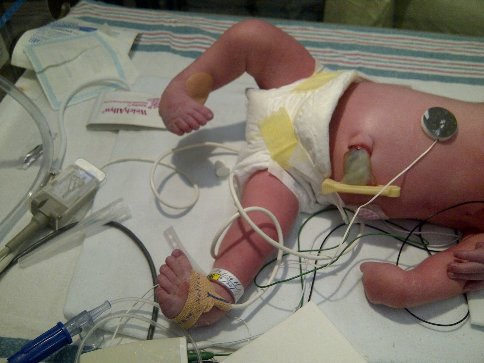 Hope for Arthrogryposis: March 2013