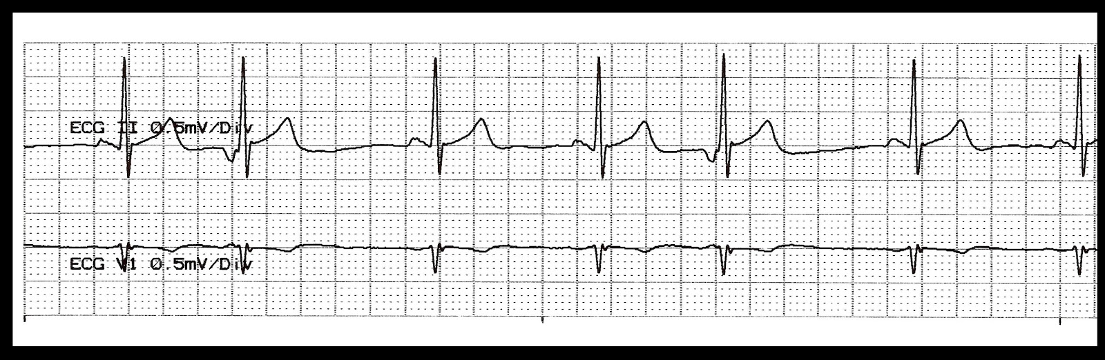 Basic EKG Rhythm Test 34