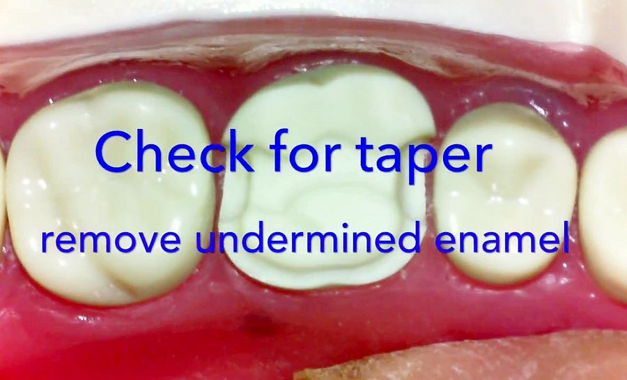 CERAMIC ONLAY: MOD on a Maxillary First Molar. - Dr. Richard G. Stevenson