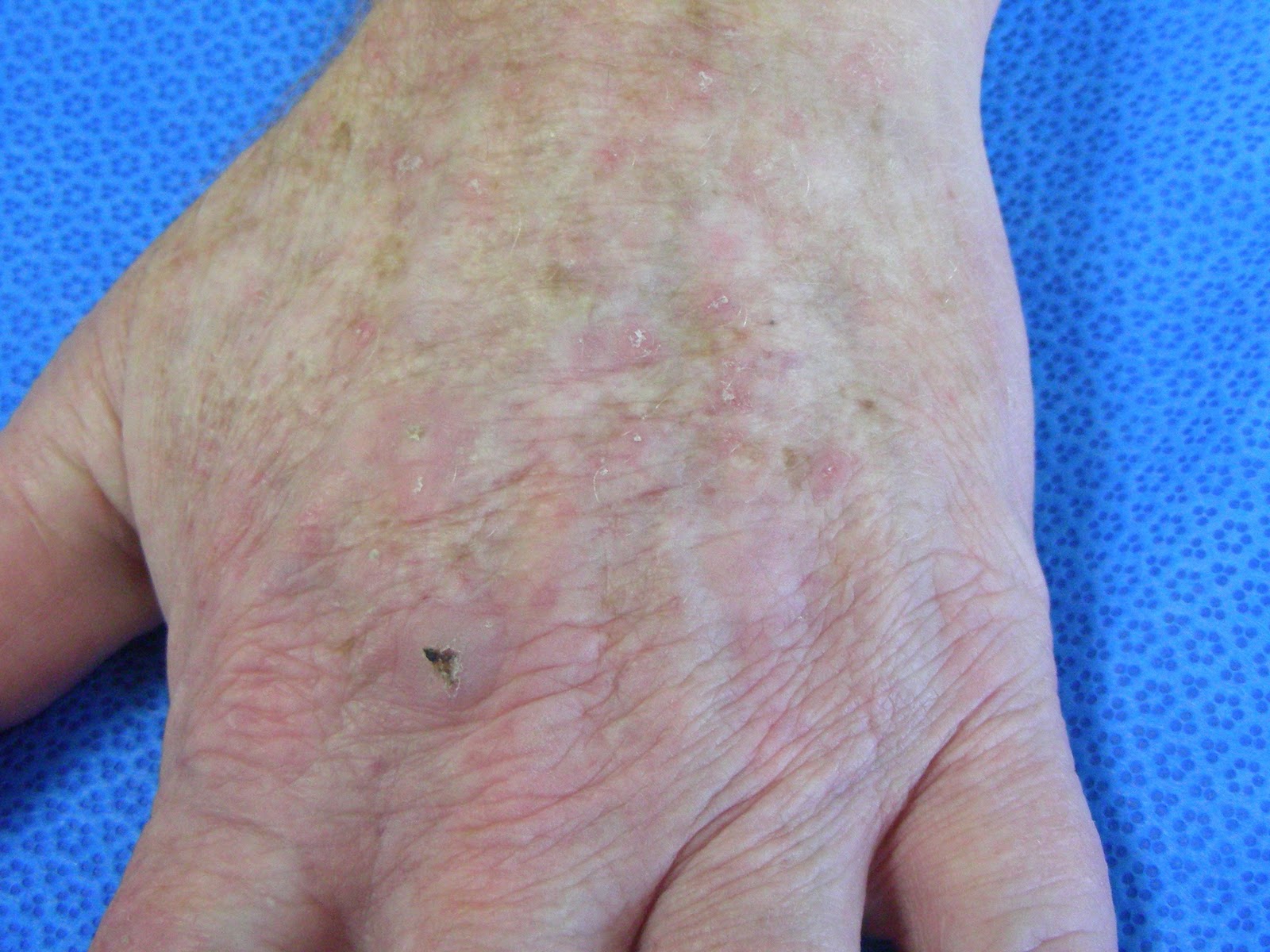 Hand Actinic Keratosis Hand At Two Years After Treatment, Showing