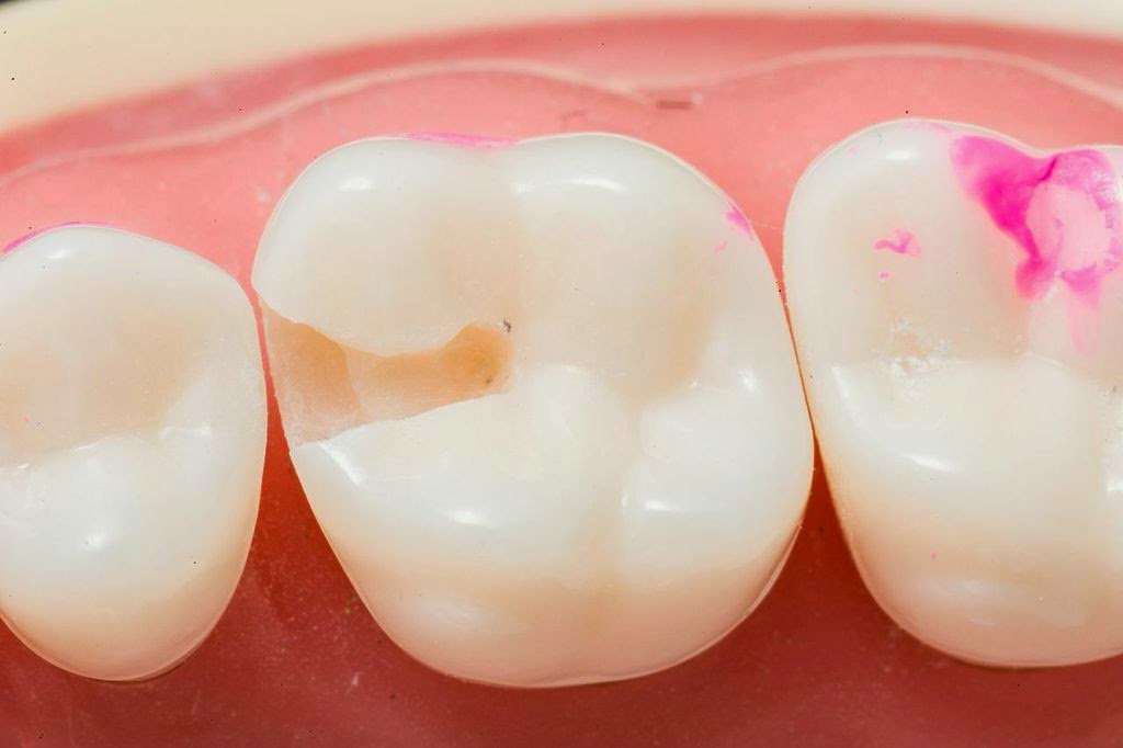 Dental Portfolio : Practical #2: #14 MO preparation and #12 MOD restoration