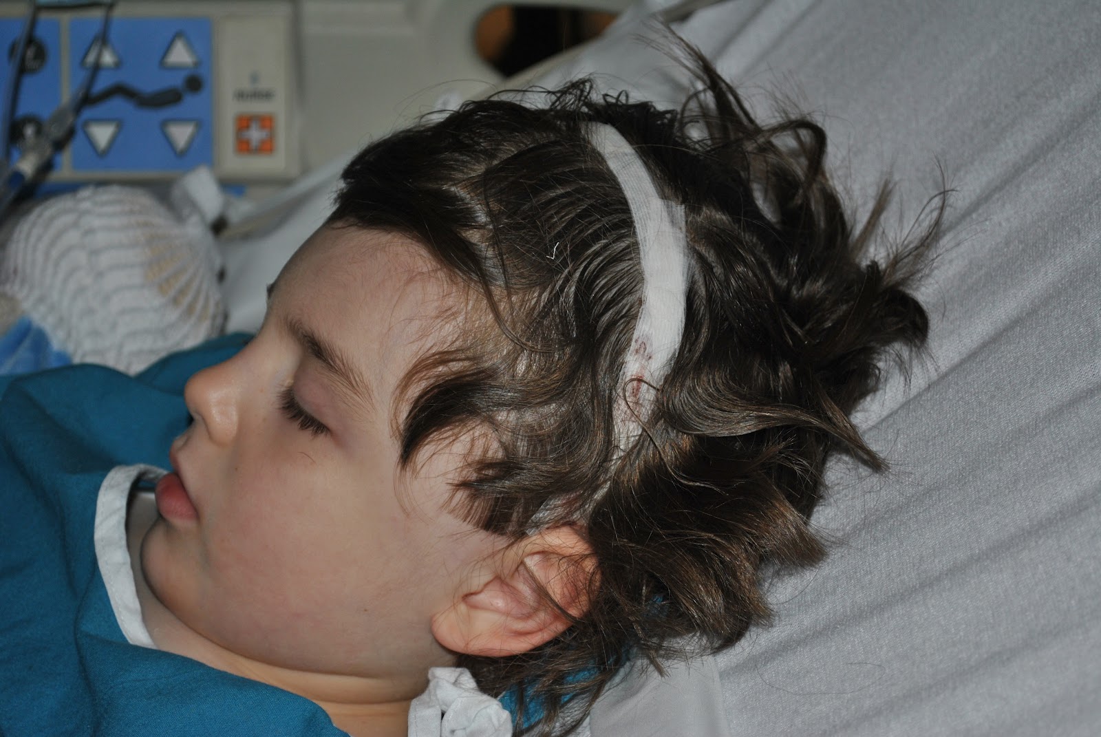 Cullan's Journey Through Metopic Craniosynostosis: The Second Surgery 2011