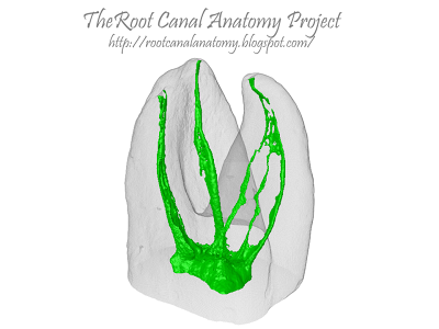 The Root Canal Anatomy Project: Middle Mesial Canal: Maxillary First Molar