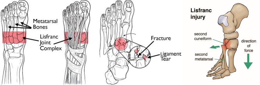 Lisfranc injury: A runners worst nightmare: The Lisfranc injury ...