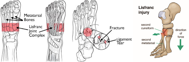 Lisfranc injury: A runners worst nightmare: The Lisfranc injury ...