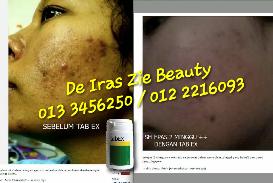 We Call It Miracle - TabEx New Upgraded Formula (Gluthatione Tablet ...