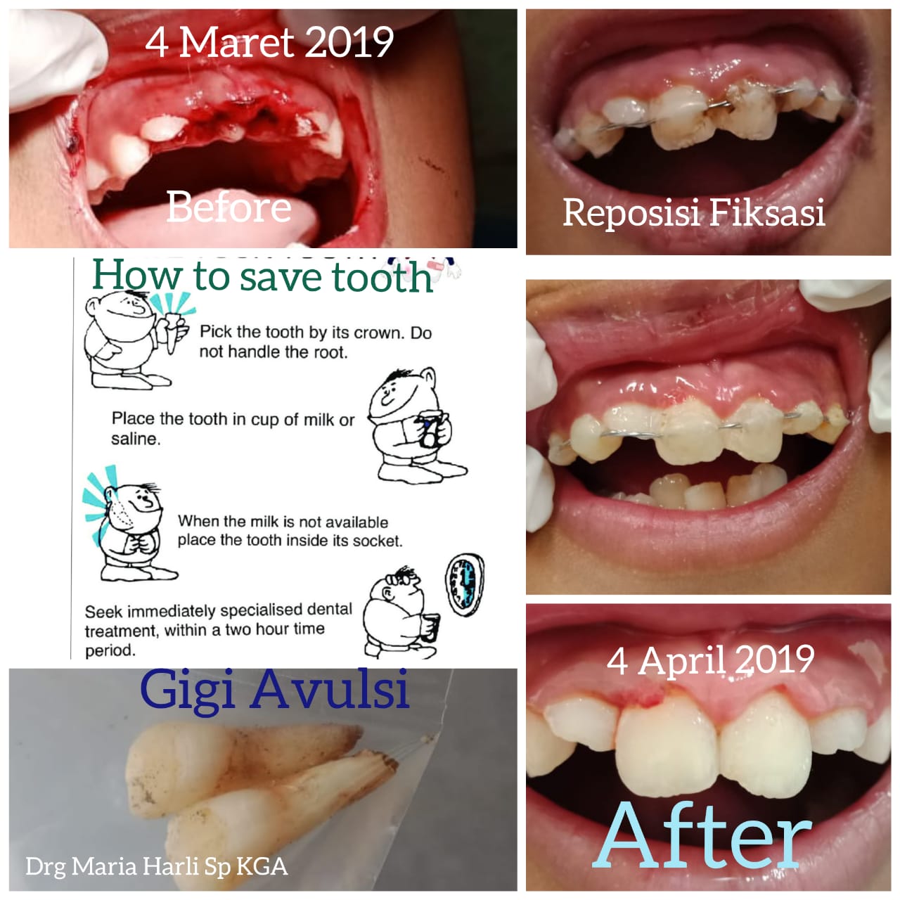 Spesialis Gigi Anak Depok