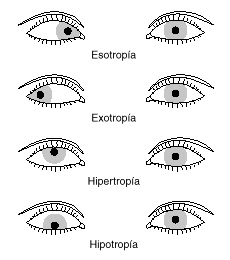 Test empleados en optometria : HETEROFORIAS