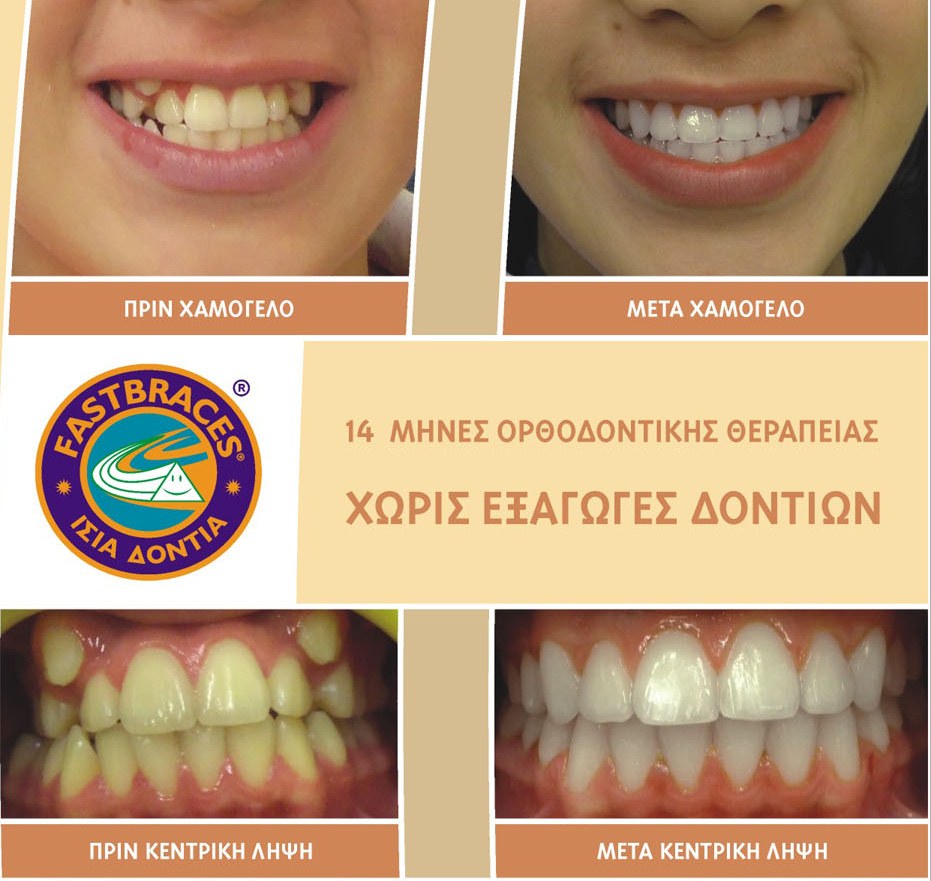 ΠΕΡΙΒΑΛΛΟΝ ΥΓΕΙΑ ΟΙΚΟΛΟΓΙΑ: ΟΡΘΟΔΟΝΤΙΚΗ (ΙΣΙΑ ΔΟΝΤΙΑ) ΣΕ ΛΙΓΟΤΕΡΟ ΧΡΟΝΟ ...