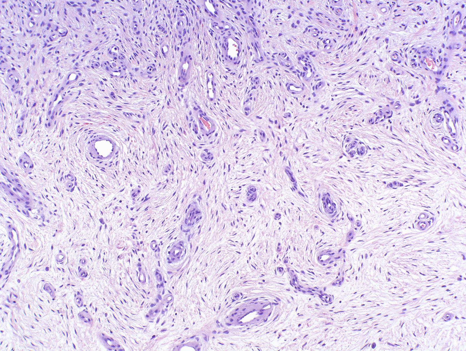 VIRTUAL GRAND ROUNDS IN DERMATOLOGY 2.0: Superficial Acral Fibromyxoma