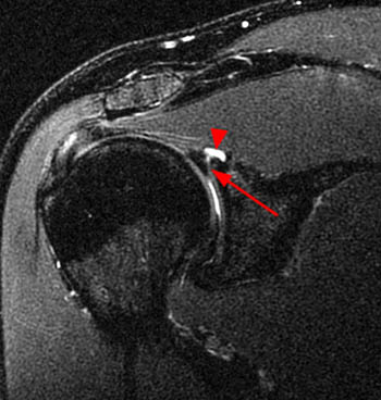 MRI Musculo-Skeletal Section: Labrum