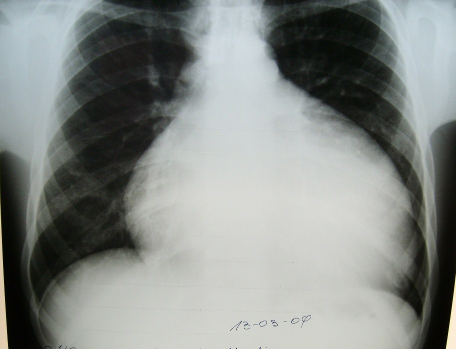 Sistemas Biológicos: Cardiomegalia - Imagens