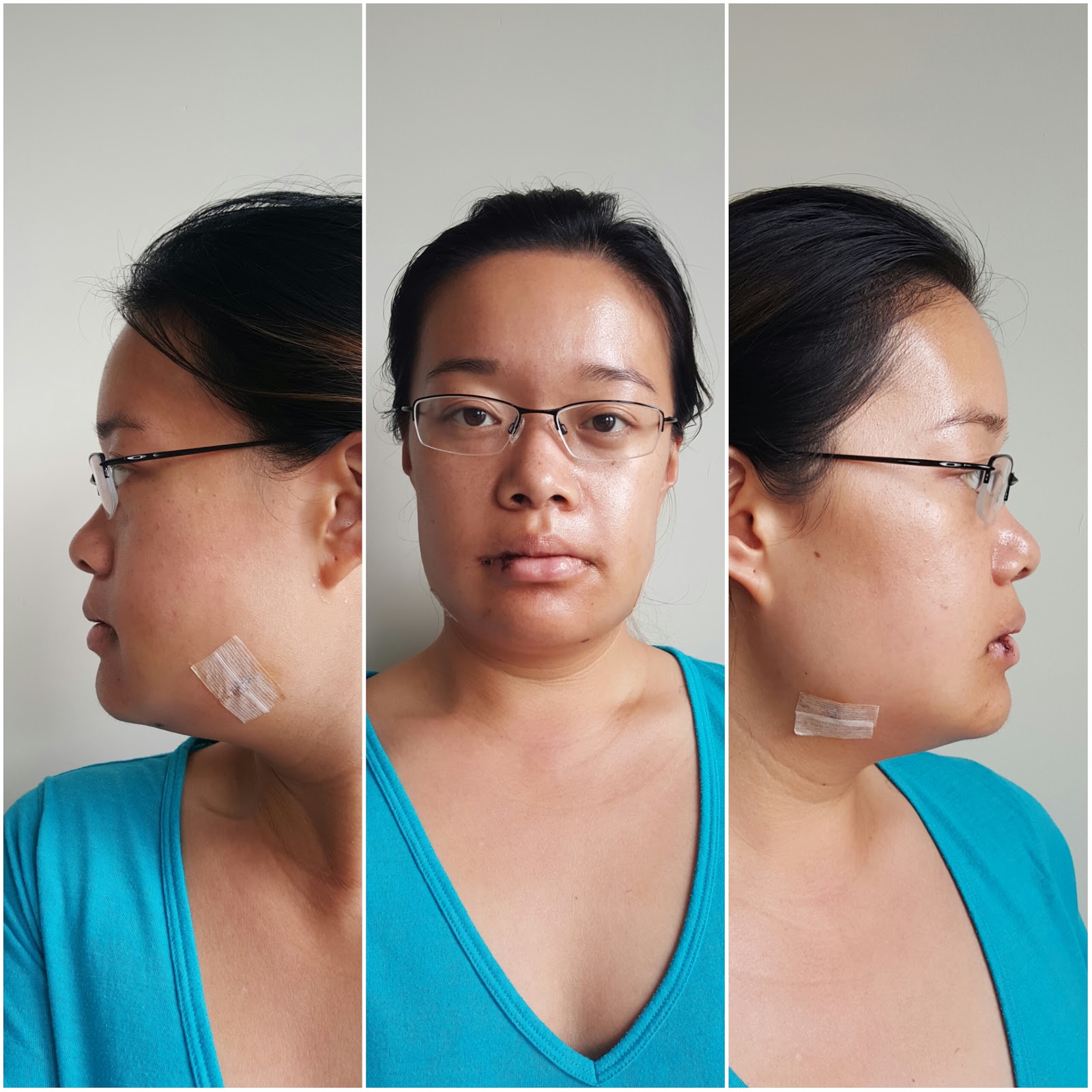 Tina's Double Jaw Surgery: Day 3: Potato Head and Snot!