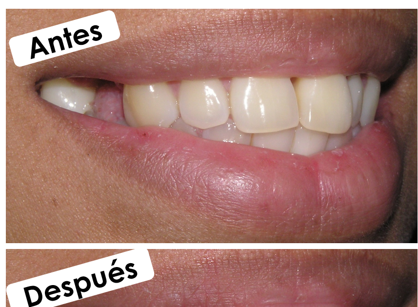 ODONTOESTETICA A TU ALCANCE: PRÓTESIS PARCIAL REMOVIBLE FLEXIBLE. Caso ...