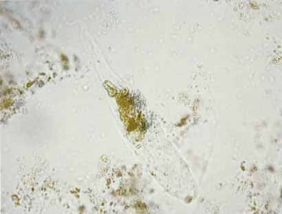 [Haematology] Microscopic Examination of Urinary Sediment ...