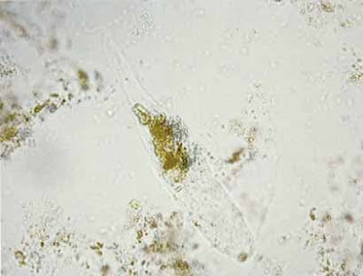 [Haematology] Microscopic Examination of Urinary Sediment ...