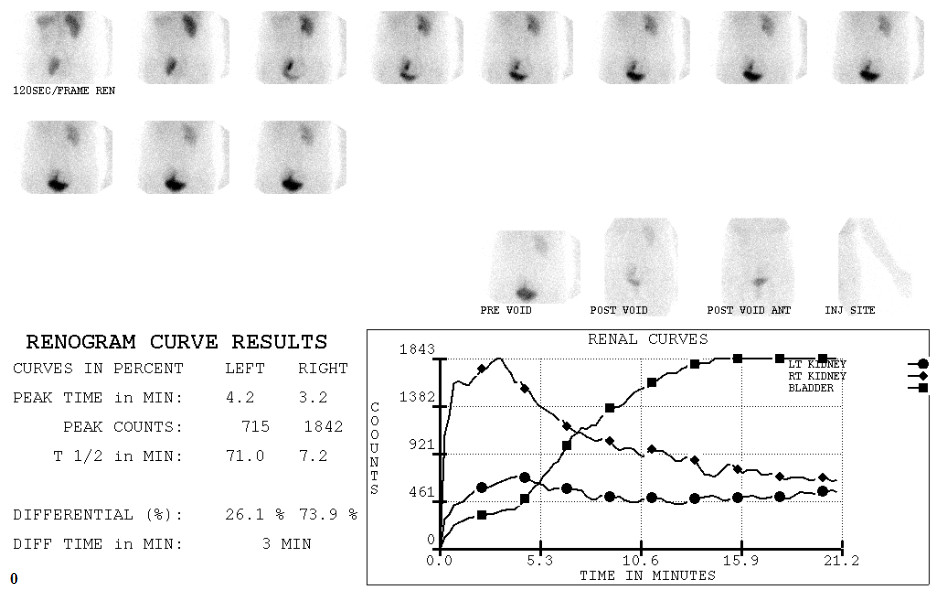 NuCleaR MuNkeE: Split Renal Function in a Pelvic Kidney