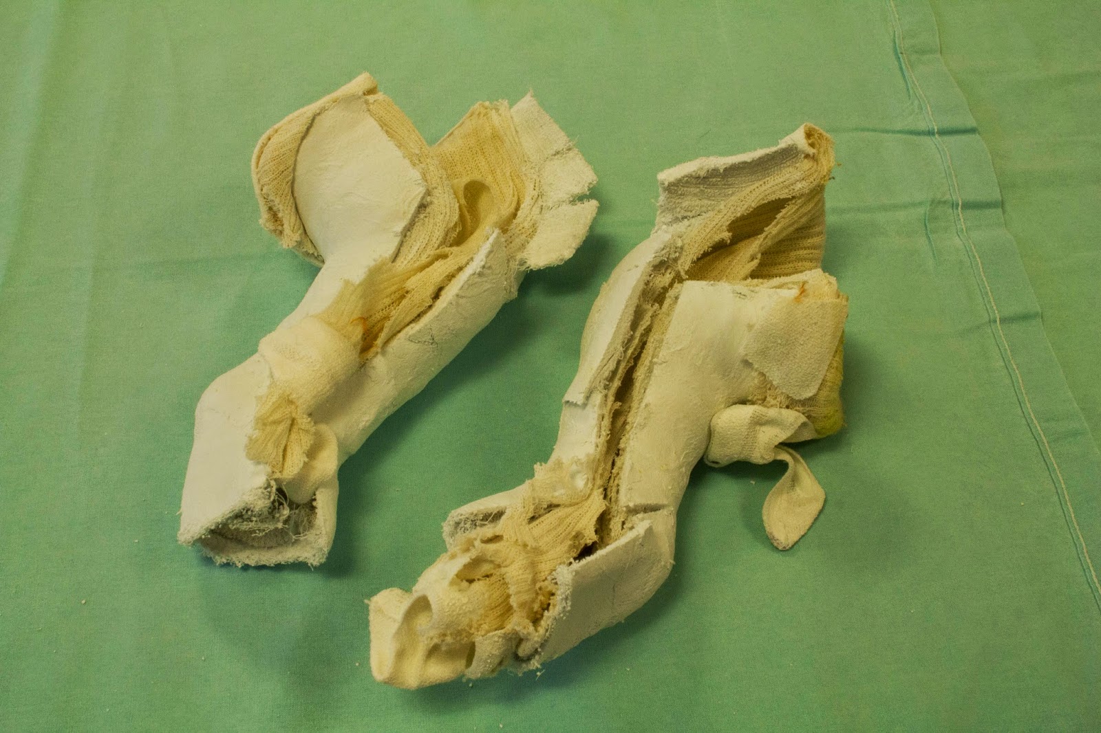 Pieds Bots Varus Equin Idiopathique: juillet 2014