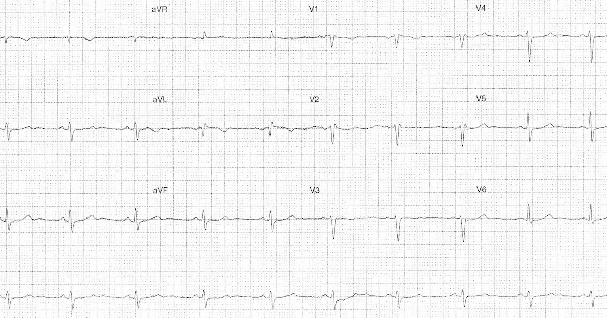 ECG of the Week: ECG of the Week - 15th October 2018
