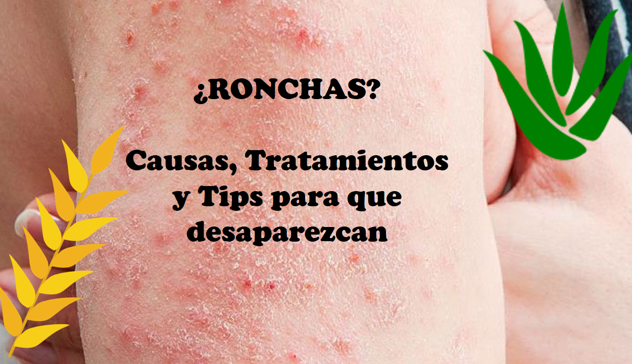 ¿Ronchas? 😫 Deja de rascarte. Descubre Causas, Tratamientos y Tips para ...