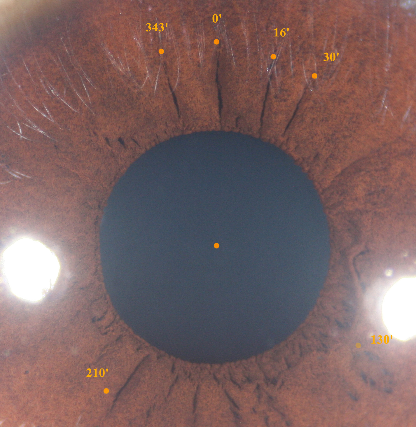 Modern & Multidimensional Iridology: Frontal Arcus, Radial Furrows ...