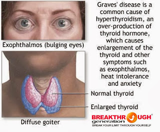 1ST STEP in UNDERSTANDING the BODY: STRUMA | HIPERTIROID | BASEDOW