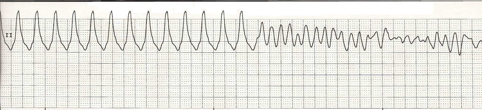 EKG Rhythm Strips 33