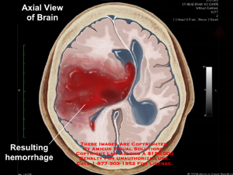 Brain hemorrhage symptoms and treatments - Life style and Fitness