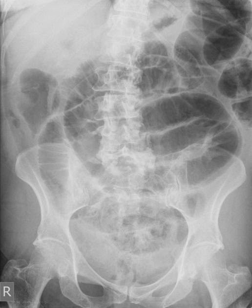 Tecnicos Radiologos: Signo Radiológico de Rigler, o de 'Doble pared' en ...