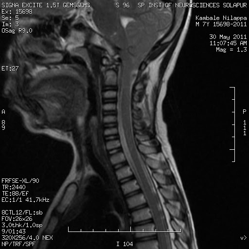 Dr Balaji Anvekar FRCR: Arnold Chiari type I malformation MRI