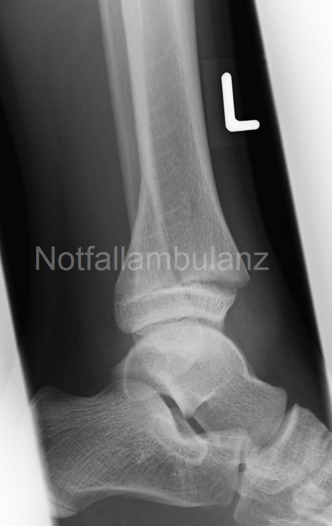 Brennpunkt Notaufnahme: Fall 16: Kindliche Distorsion des OSG Befunde ...