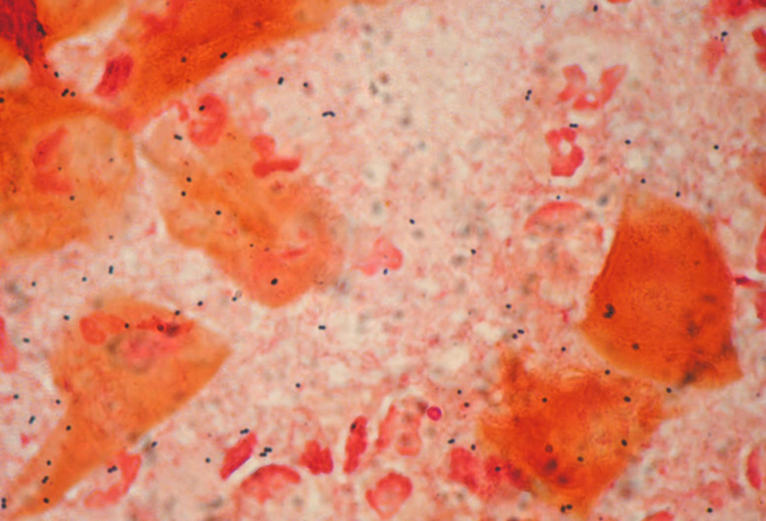 MEDICINA: INFECCIÓN GONOCÓCICA