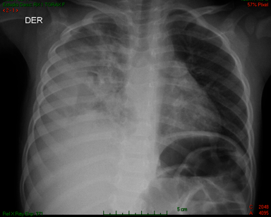 INTENSIVOS PEDIATRICOS: MANEJO DE EMPIEMA EN PEDIATRIA