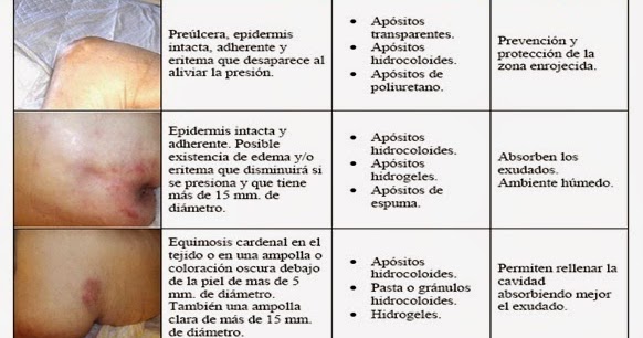TIC: Grados de las úlceras por presión: