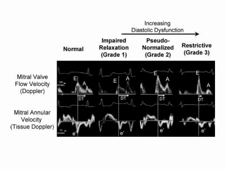 Manuali di Medicina Intensiva: Fisiologia e Fisiopatologia dell'atrio ...
