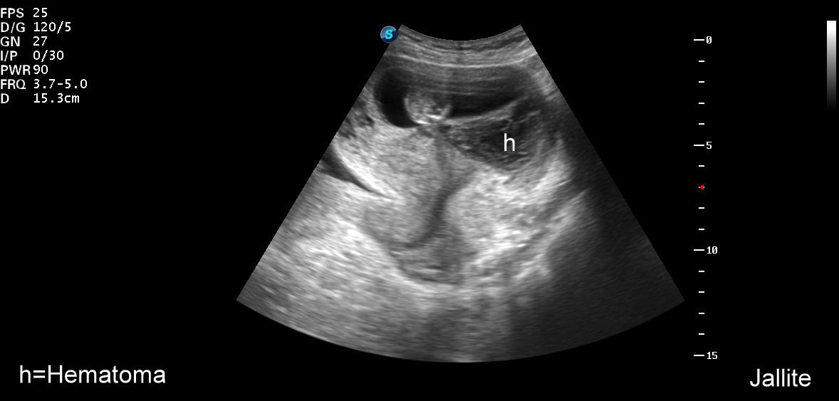 Hematoma Placentario