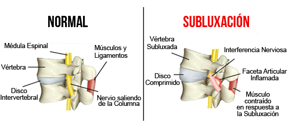 ¿Qué es un complejo de subluxación vertebral?